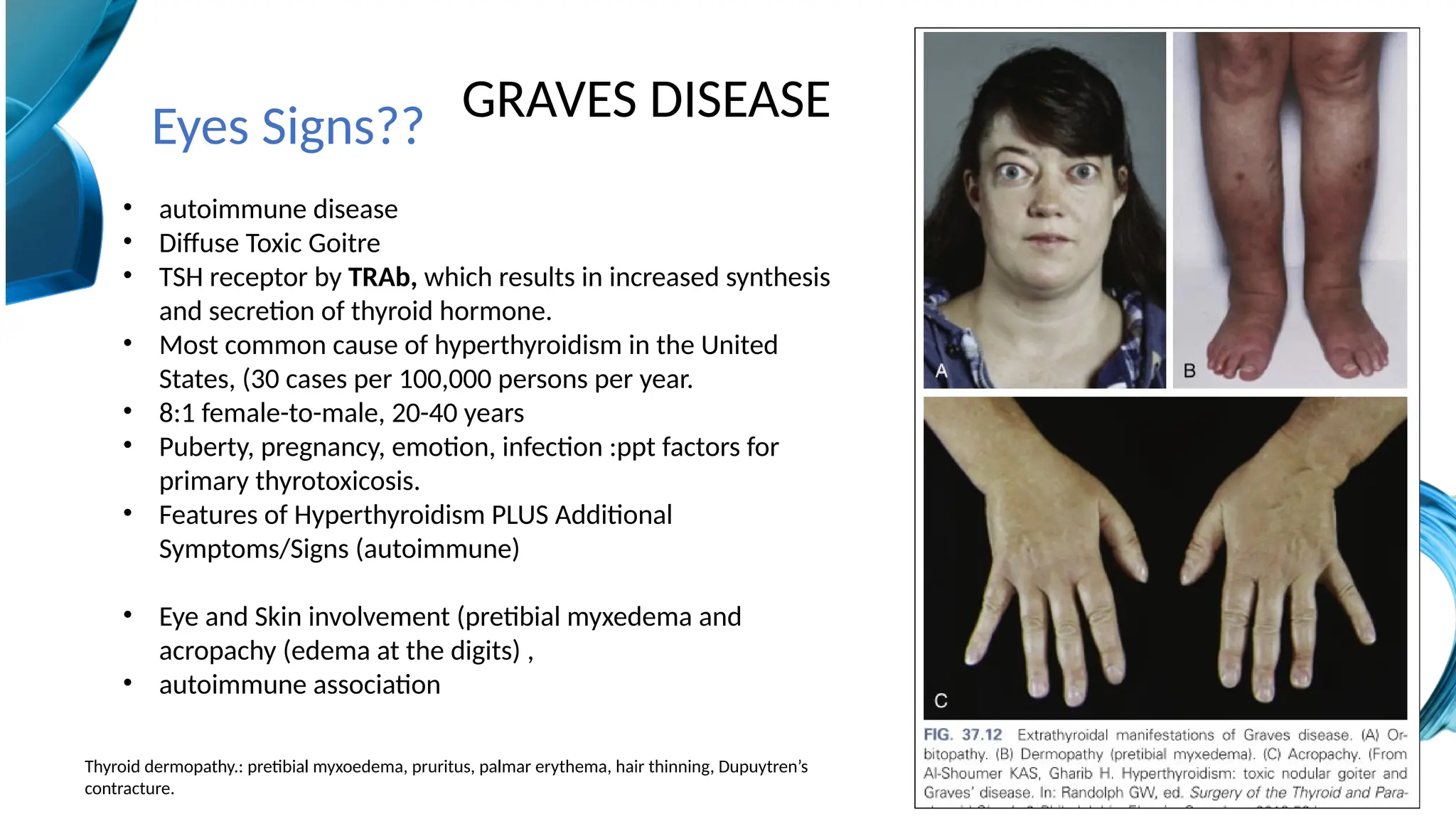 Benign Thyroid Diseases: Hypothyroidism and Hyperthyroidism; Graves ...