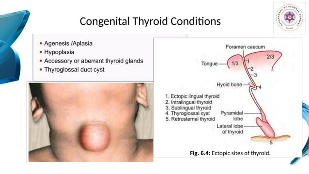 Benign Thyroid Diseases: Hypothyroidism and Hyperthyroidism; Graves Disease, Hashimoto ...