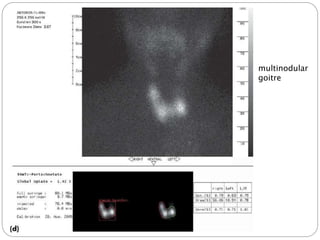 Benign thyroid diseases | PPTX