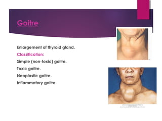 Benign thyroid disorders_(lecture) | PPT