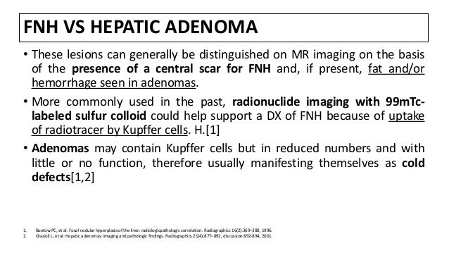 Benign tumor of liver : Hepatocellular origin