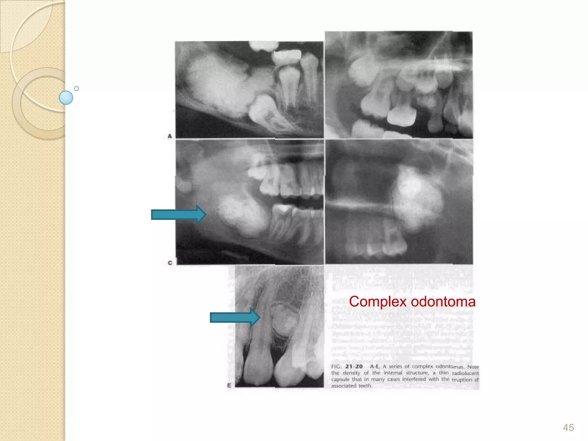 Benign tumors of jaw | PPT