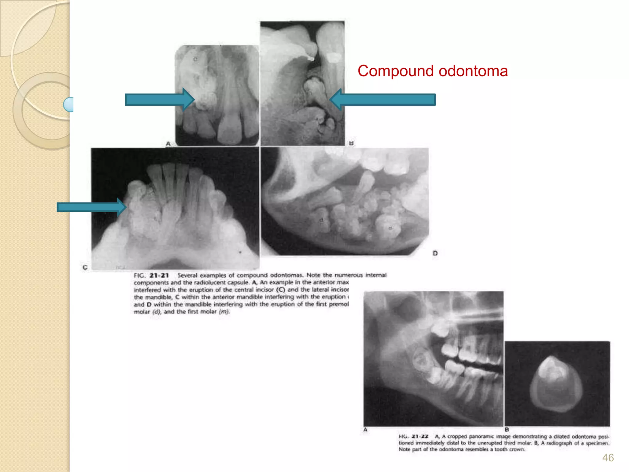 Benign tumors of jaw | PPT