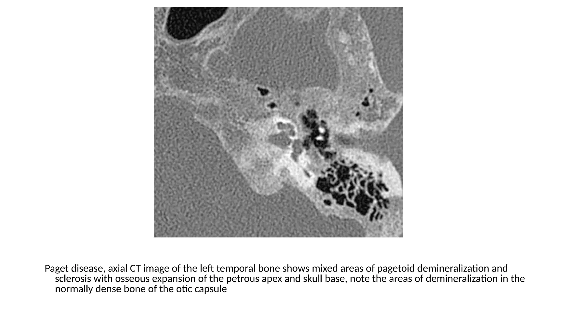 Benign Tumors of Temporal Bone simplified | PPTX