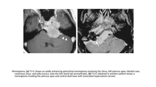 Benign Tumors of Temporal Bone simplified | PPTX