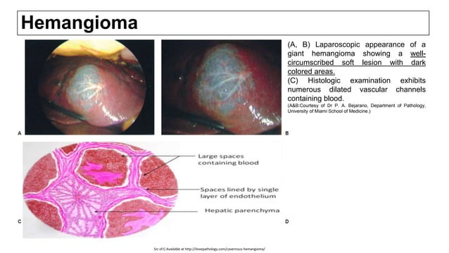 Benign tumour of liver hemangioma | PPTX | Blood Disorders | Diseases ...