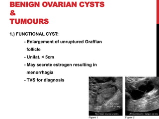 Benign tumours,cysts | PPTX