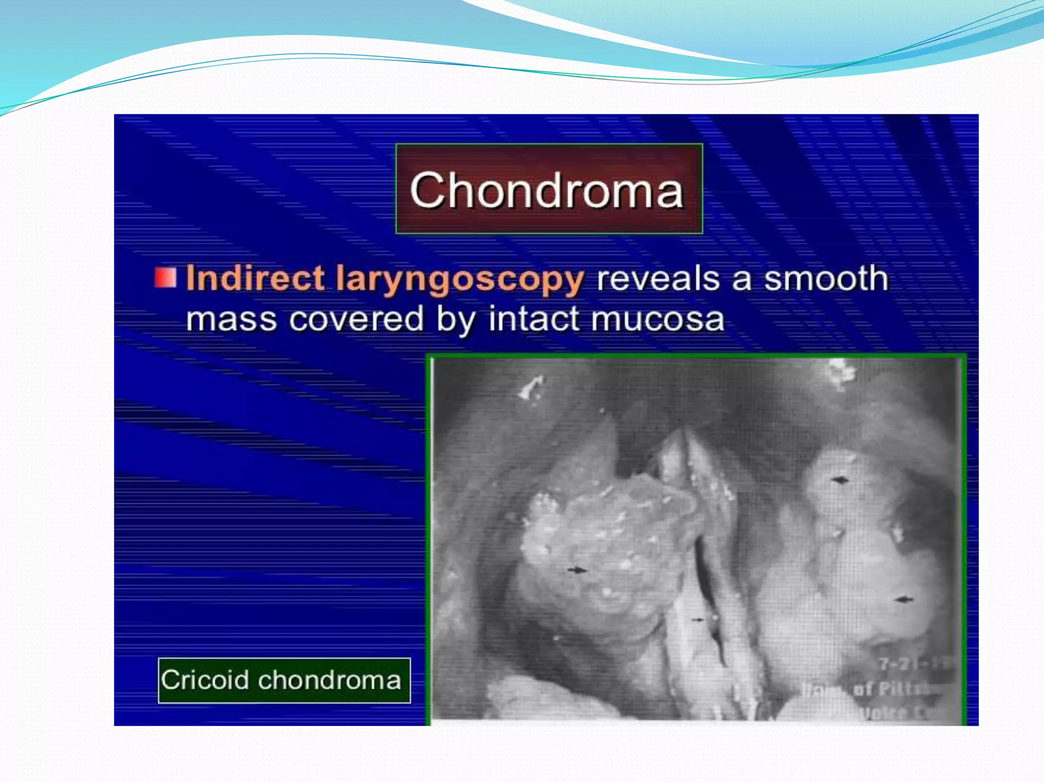 Benign tumours of larynx | PPTX | Ear, Nose and Throat Conditions ...