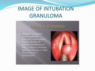 Benign tumours of larynx | PPT