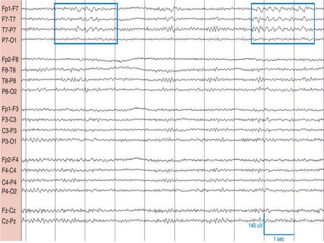 Benign variants in eeg | PPTX | Sleep Disorders | Diseases and Conditions