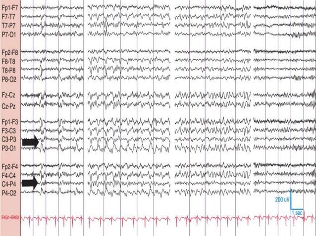 Benign variants in eeg | PPTX | Sleep Disorders | Diseases and Conditions