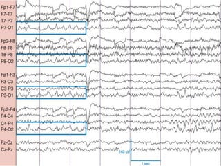 Benign variants in eeg | PPTX