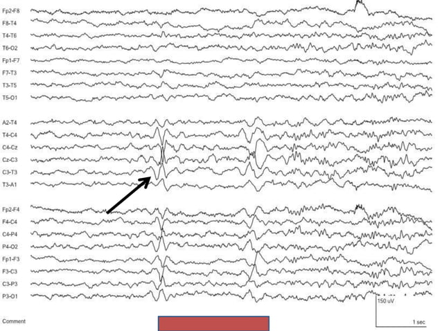 Benign variants in eeg | PPTX | Sleep Disorders | Diseases and Conditions