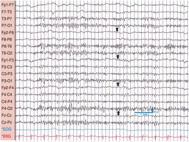 Benign variants in eeg | PPTX | Sleep Disorders | Diseases and Conditions