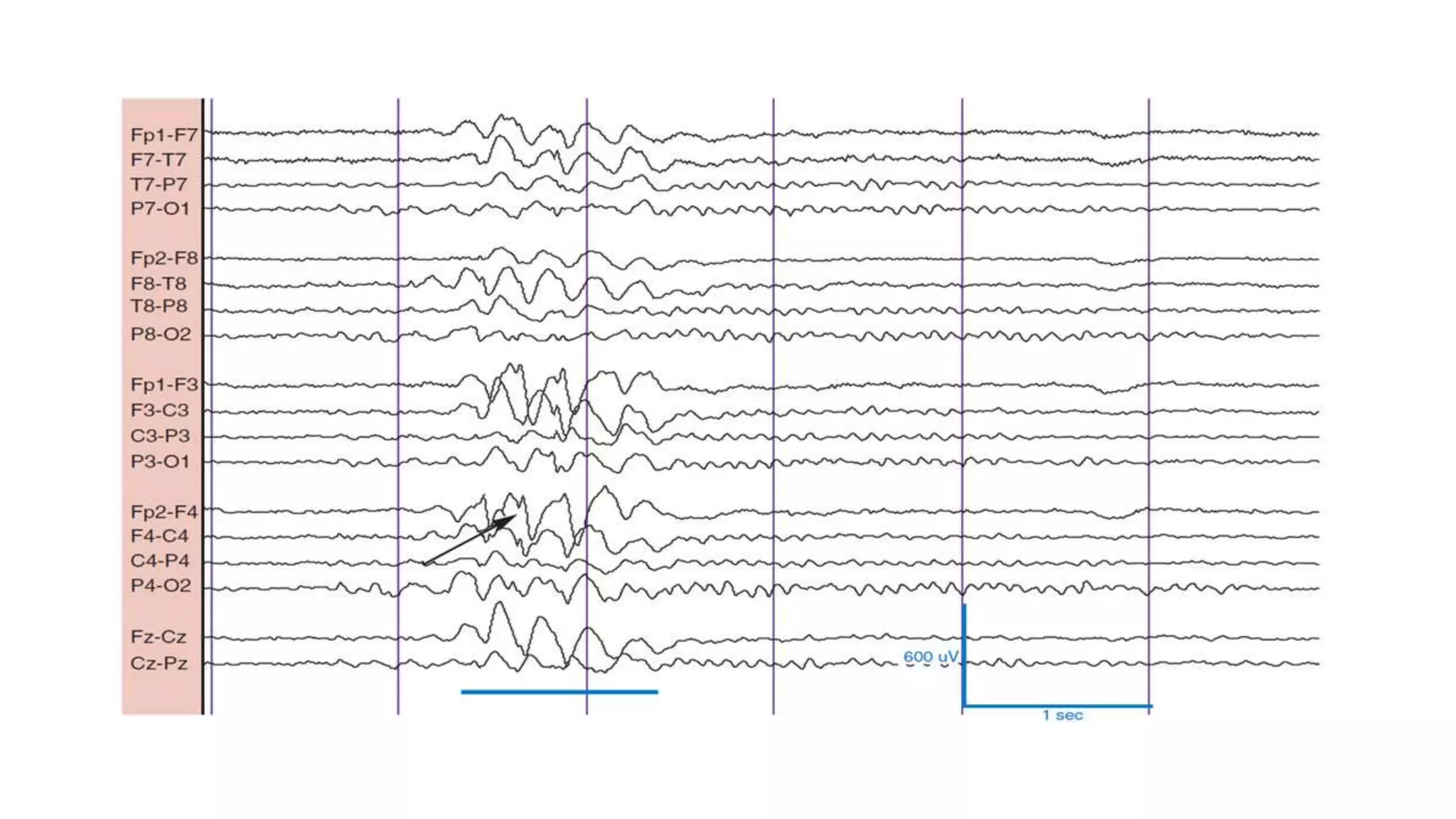 Benign variants of eeg | PPTX
