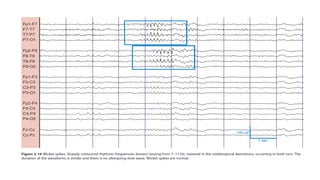 Benign variants of eeg | PPTX