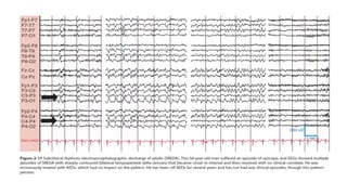 Benign variants of eeg | PPTX