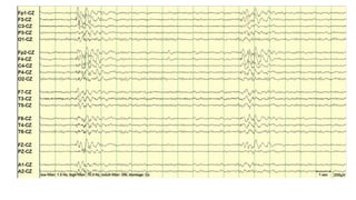 Benign variants of eeg | PPTX