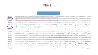 Benign variants of eeg | PPTX