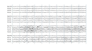 Benign variants of eeg | PPTX