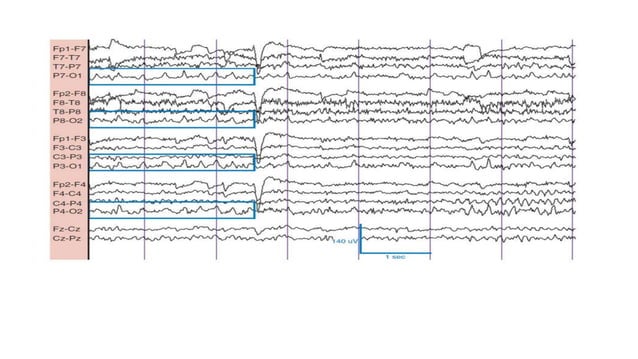 Benign variants of eeg | PPTX