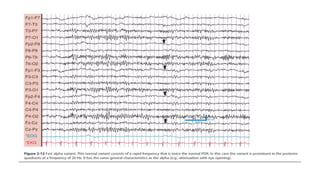 Benign variants of eeg | PPTX
