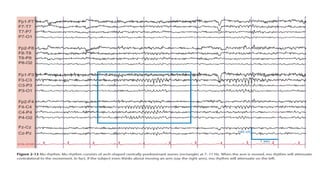 Benign variants of eeg | PPTX
