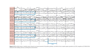 Benign variants of eeg | PPTX
