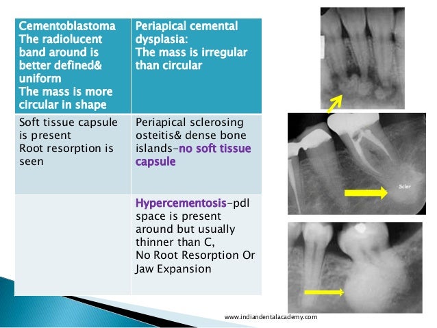 Idiopathic Osteosclerosis Vs Condensing Osteitis