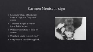 BENING AND MALIGANT GASTRIC ULCERS- Barium meal findings.pptx