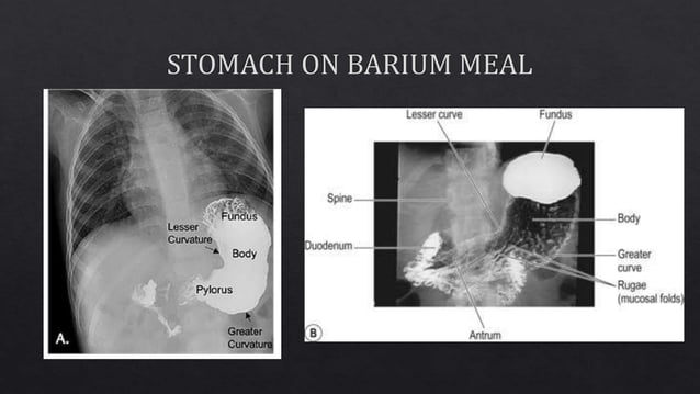 BENING AND MALIGANT GASTRIC ULCERS- Barium meal findings.pptx