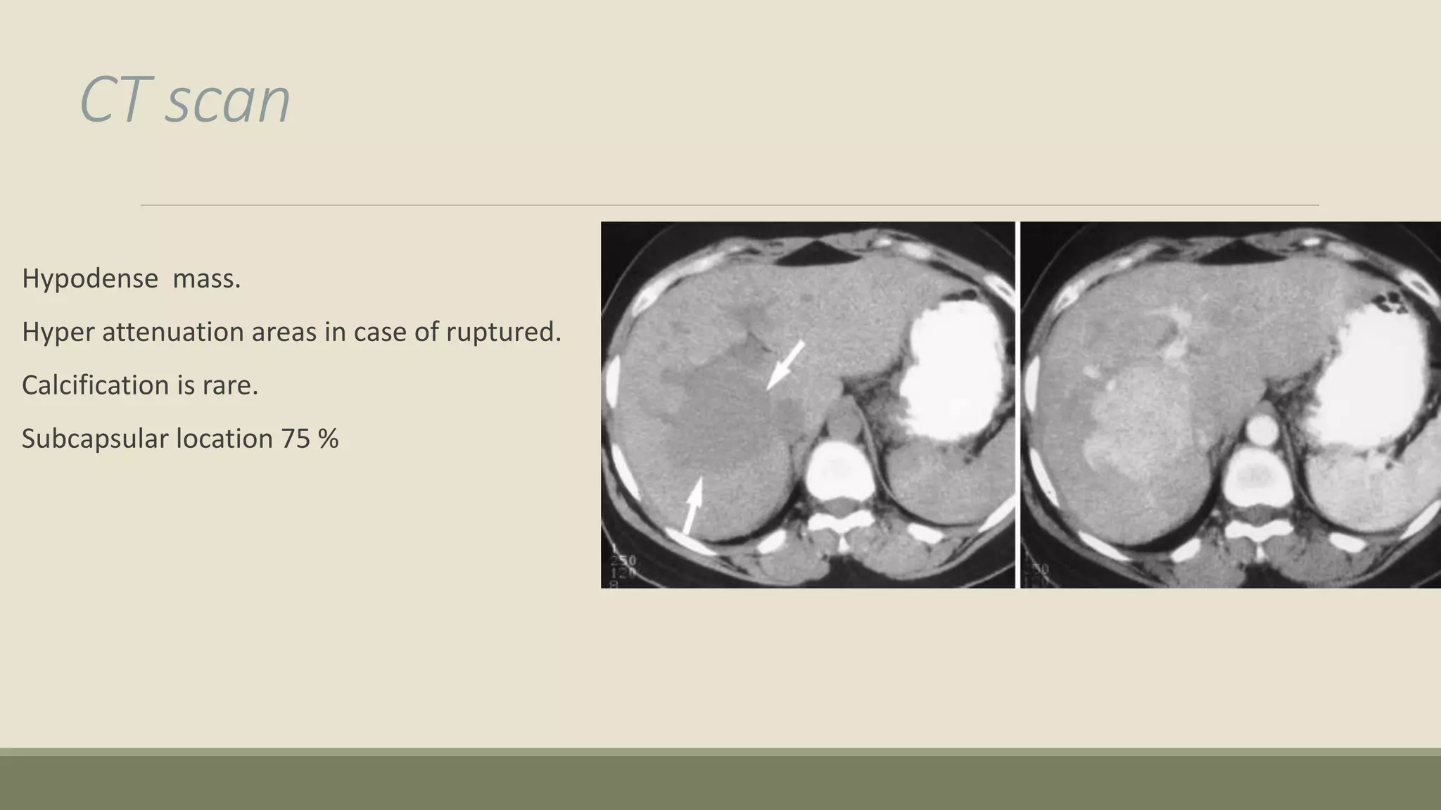 Benign hepatic masses | PPTX
