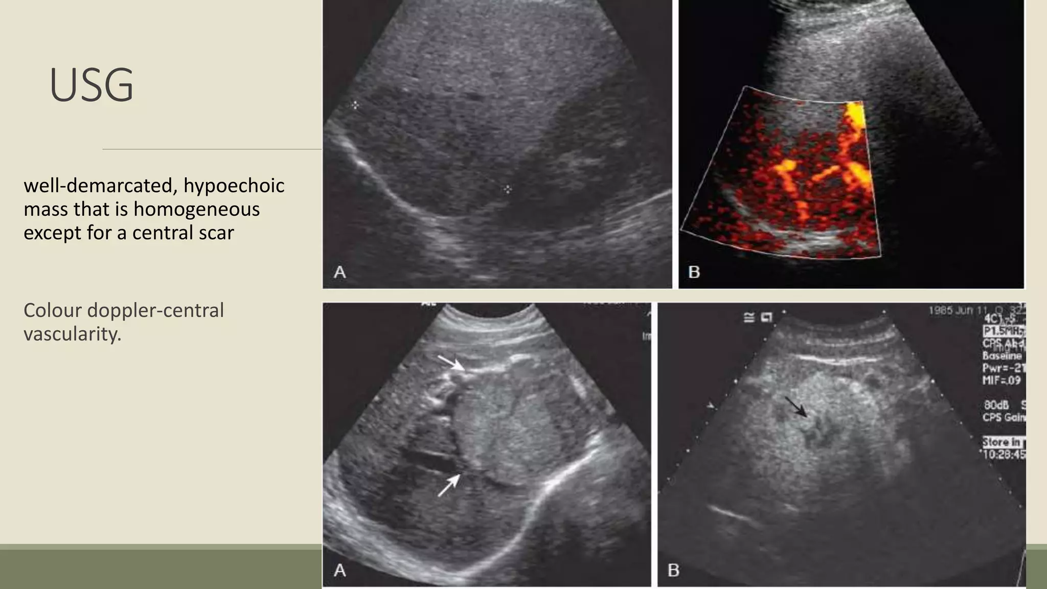 Benign hepatic masses | PPTX