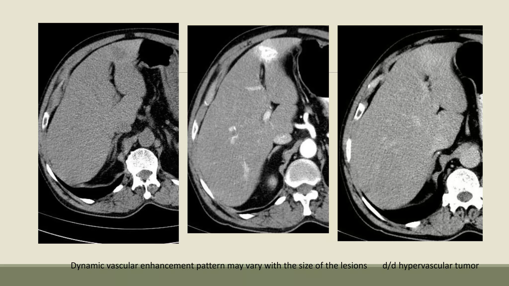 Benign hepatic masses | PPT