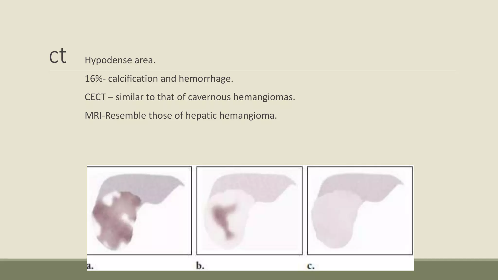 Benign hepatic masses | PPTX