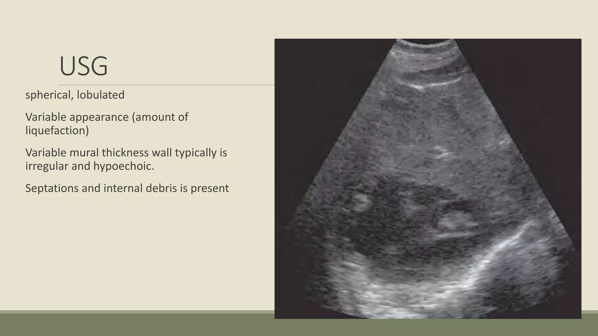 Benign hepatic masses | PPTX