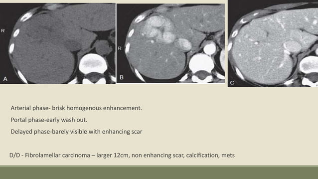 Benign hepatic masses | PPT