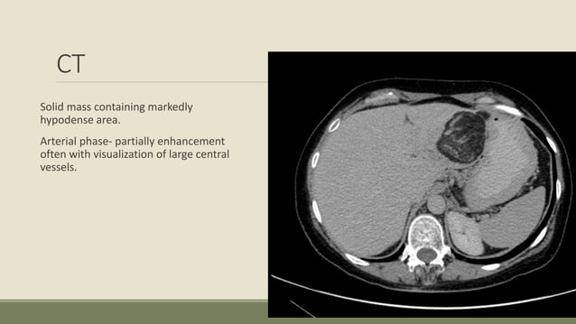 Benign hepatic masses | PPT