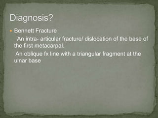 Bennet's Fracture Power Point | PPTX