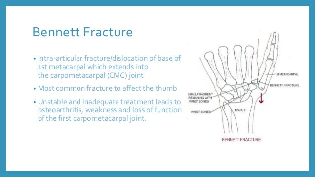 Bennett extern conference