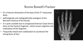 Bennett Fracture