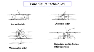 Bennett , rolando , tendon injuries | PPT
