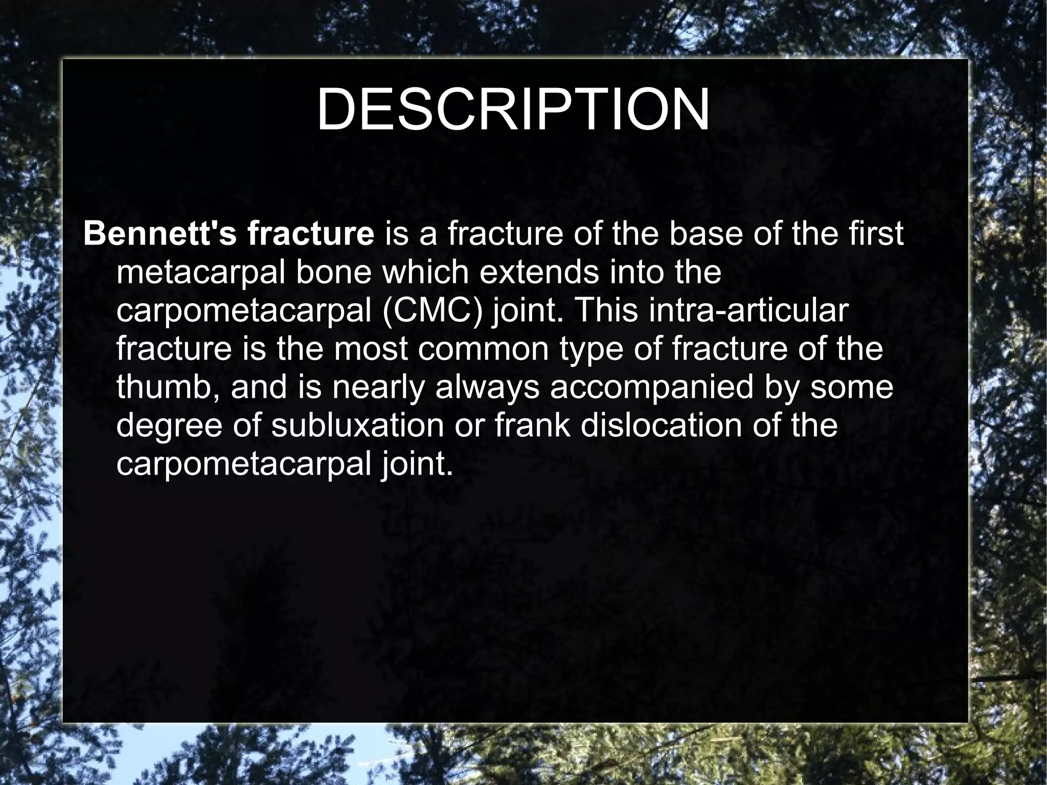 Bennetts Fracture | ODP