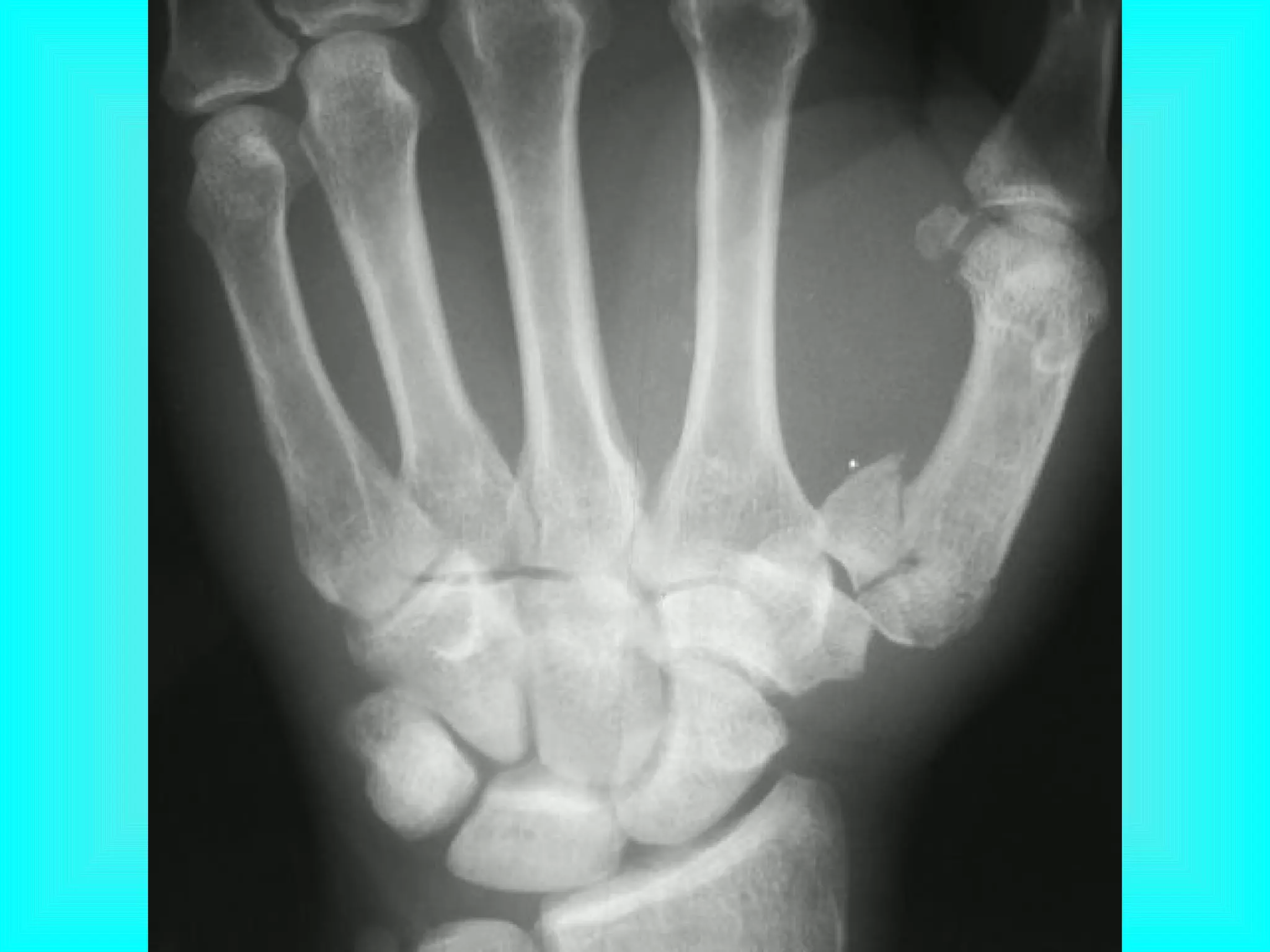 hand fractures | PPT