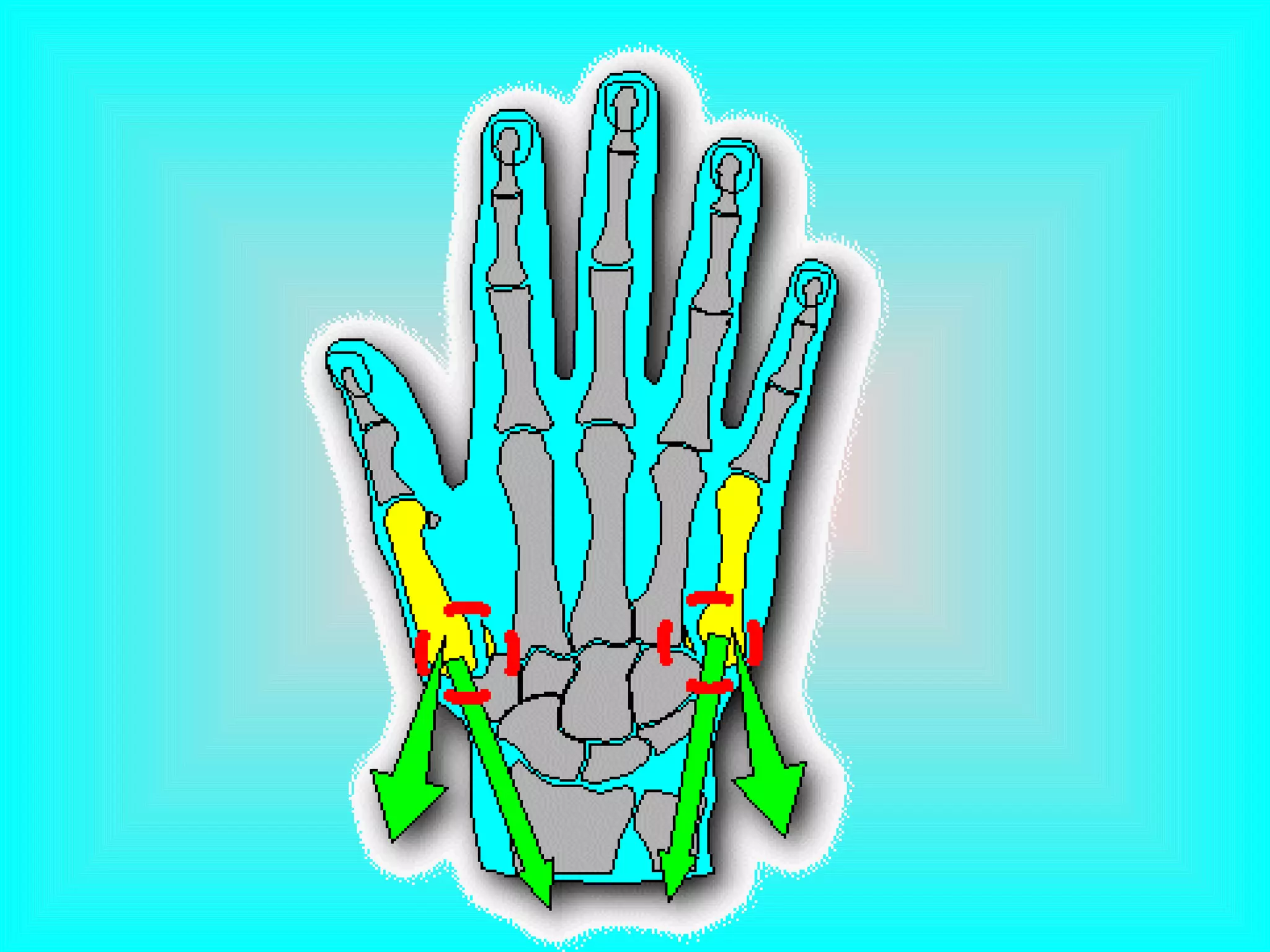 hand fractures | PPT