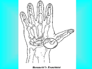 hand fractures | PPT