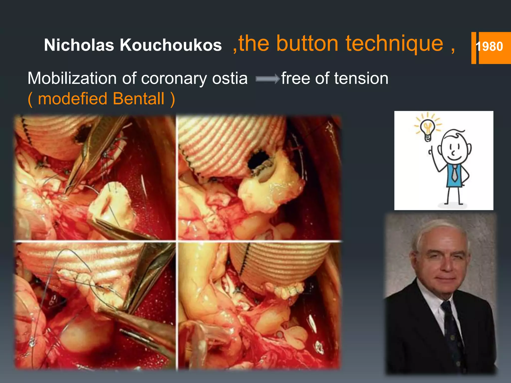 Aortic root surgery. Bentall operation | PPTX