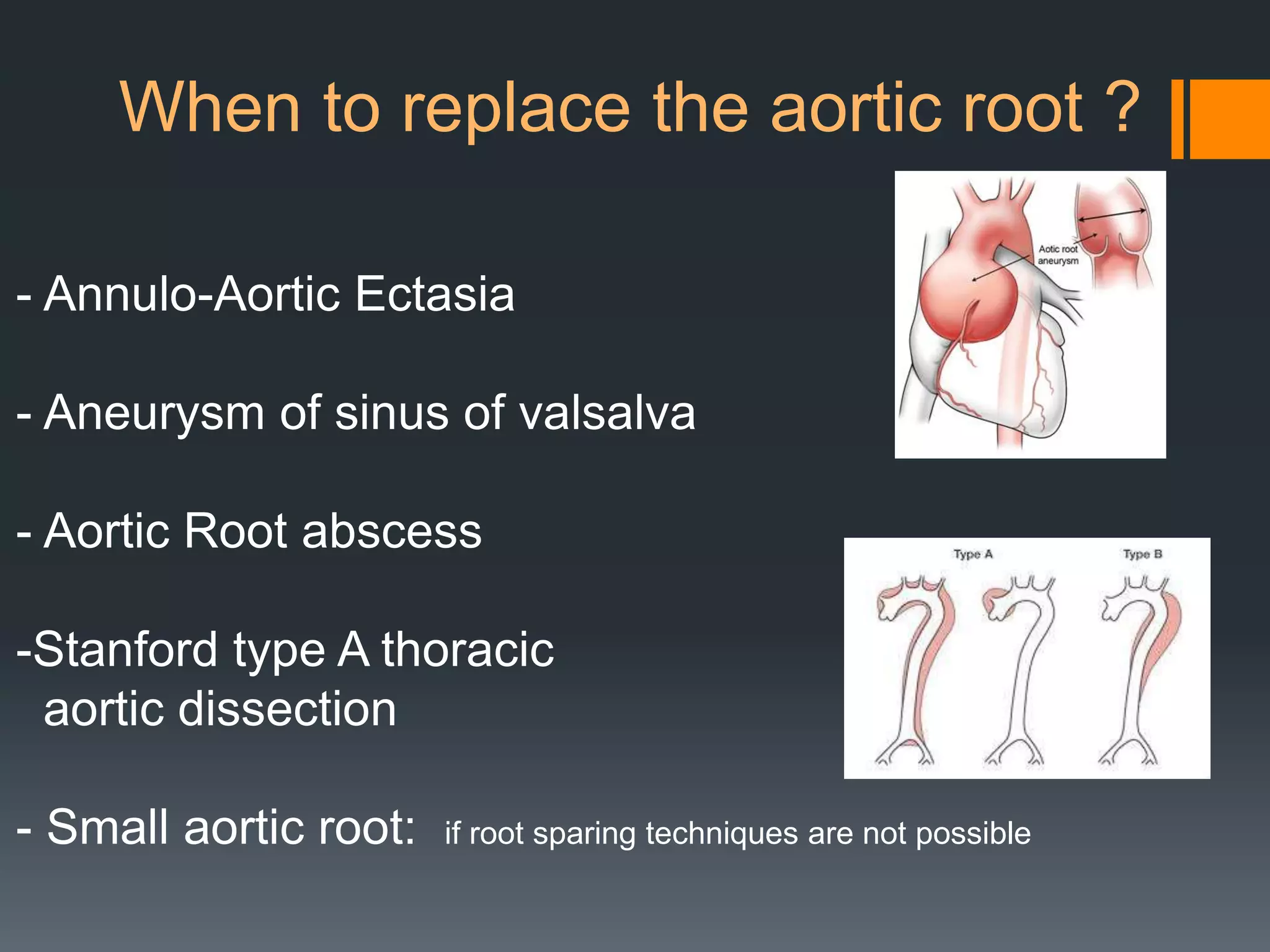 Aortic root surgery. Bentall operation | PPTX