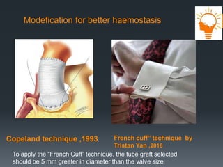 Aortic root surgery. Bentall operation | PPTX