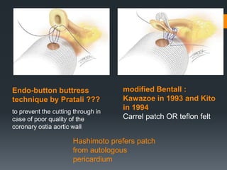 Aortic root surgery. Bentall operation | PPTX | Death, Injury, or ...